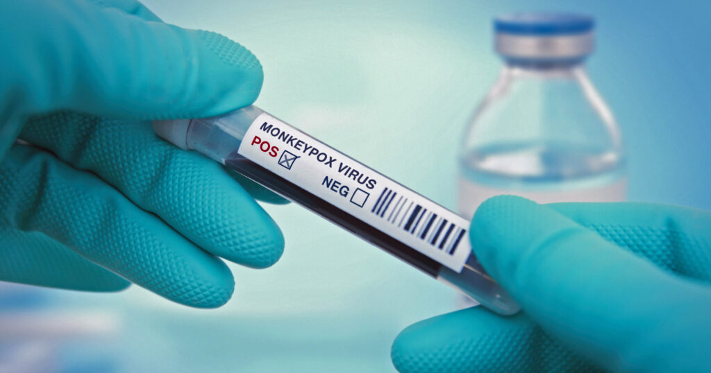 What Nurses Need to Know About Monkeypox | Vivian Community Hub